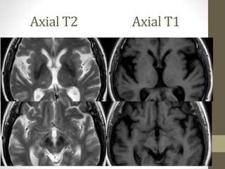 Neurodegeneretaion with Brain Iron Accumulation (NBIA) and Normal Brain ...