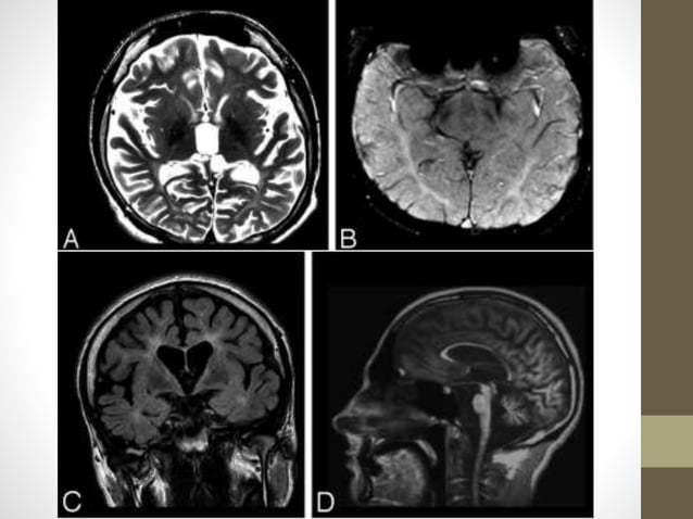 Neurodegeneretaion with Brain Iron Accumulation (NBIA) and Normal Brain ...
