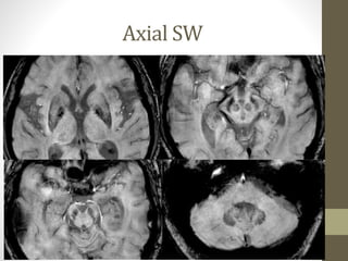 Neurodegeneretaion with Brain Iron Accumulation (NBIA) and Normal Brain ...