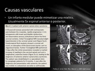 Neuromielitis óptica (enfermedad de devic).. | PPTX