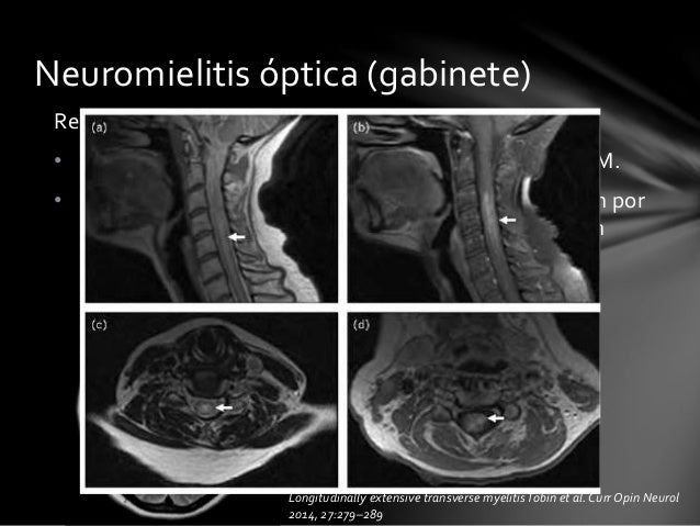 Neuromielitis óptica (enfermedad de devic)..
