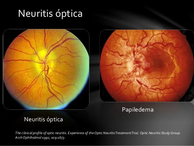 Neuromielitis óptica (enfermedad de devic)..