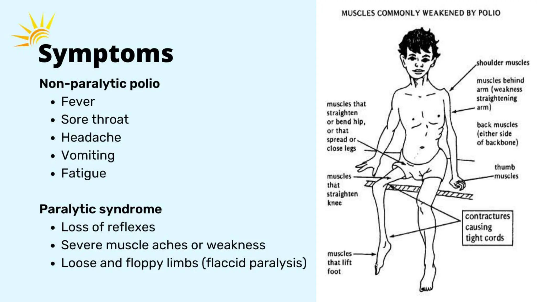 Neuromuscular UMN vs LMN teori Basic.pptx