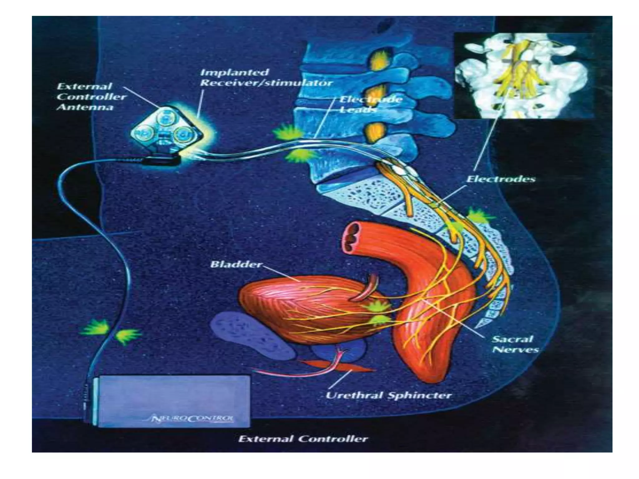 Neuromuscular electrical stimulation | PPTX