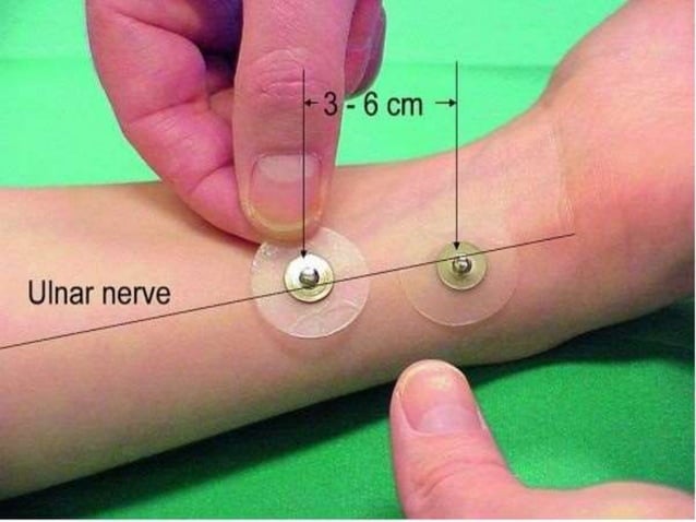 Neuromuscular monitoring | PPT