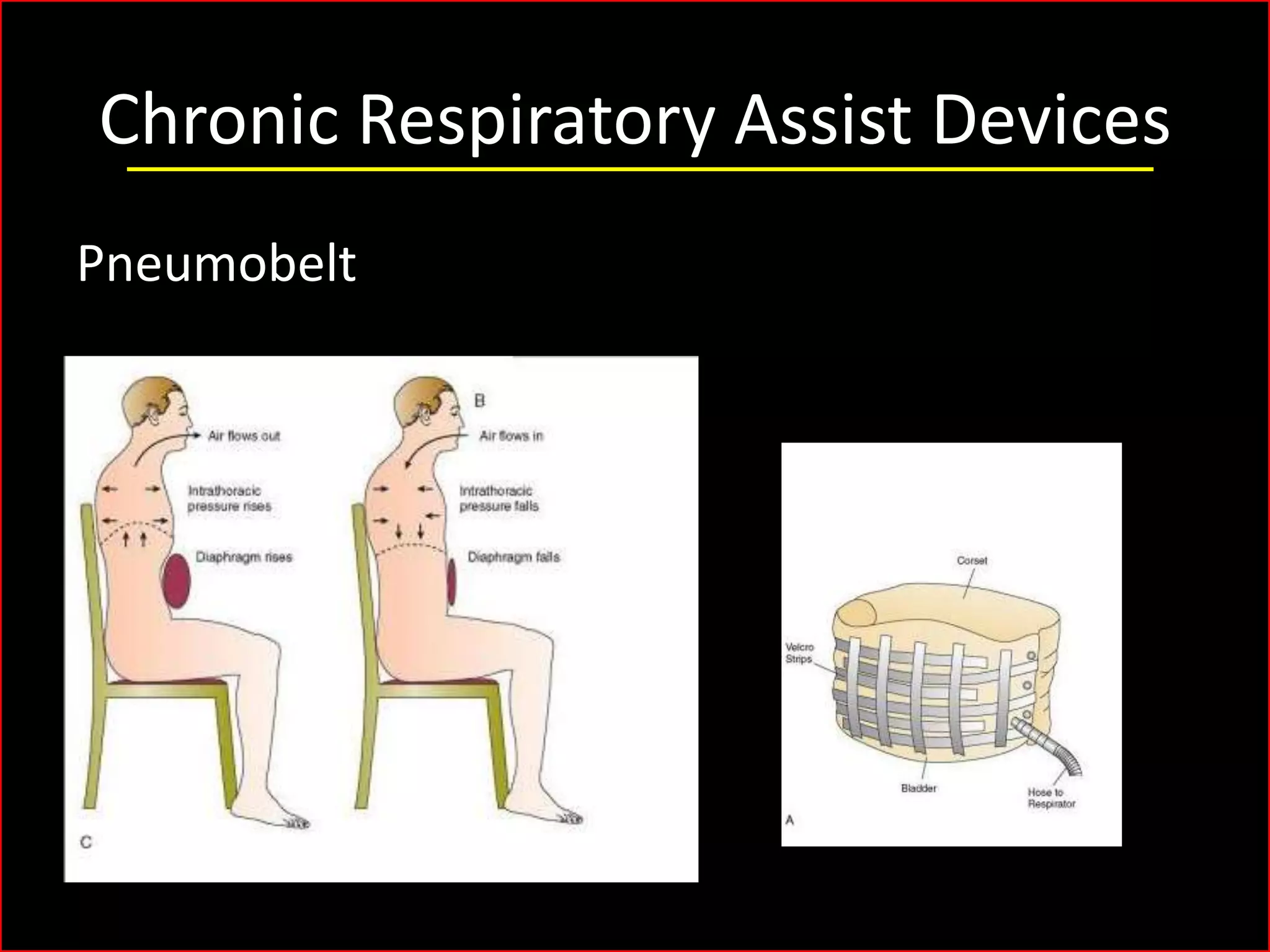 Neuromuscular Respiratory Failure | PPSX