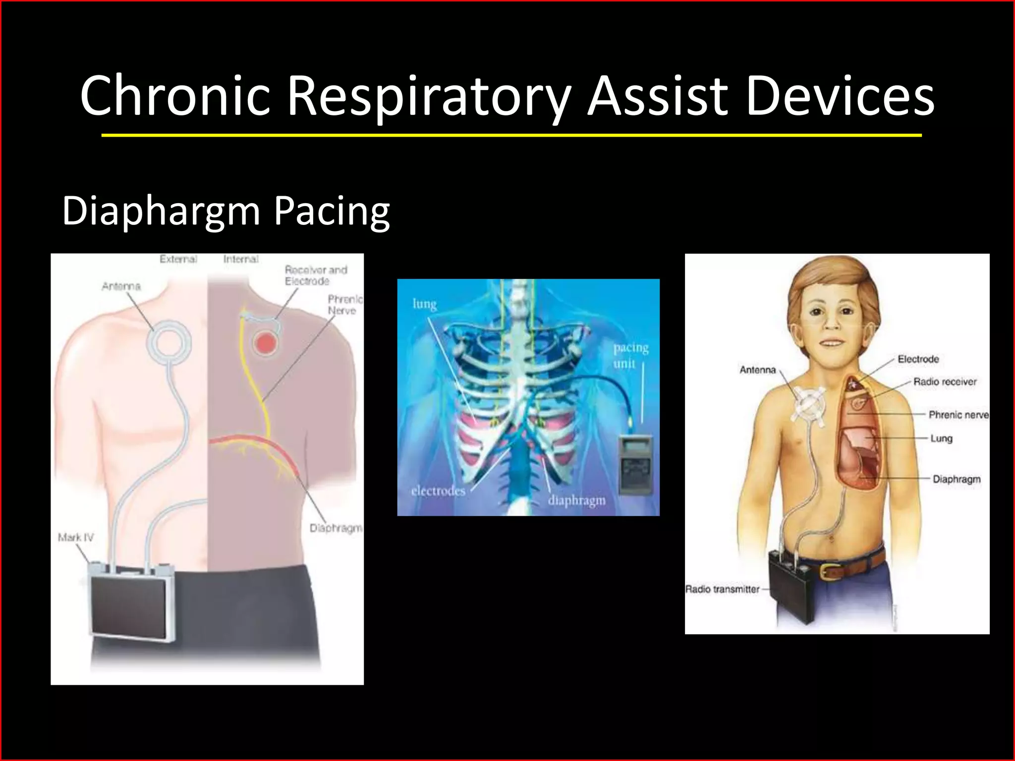 Neuromuscular Respiratory Failure | PPSX | Lung and Respiratory Health ...