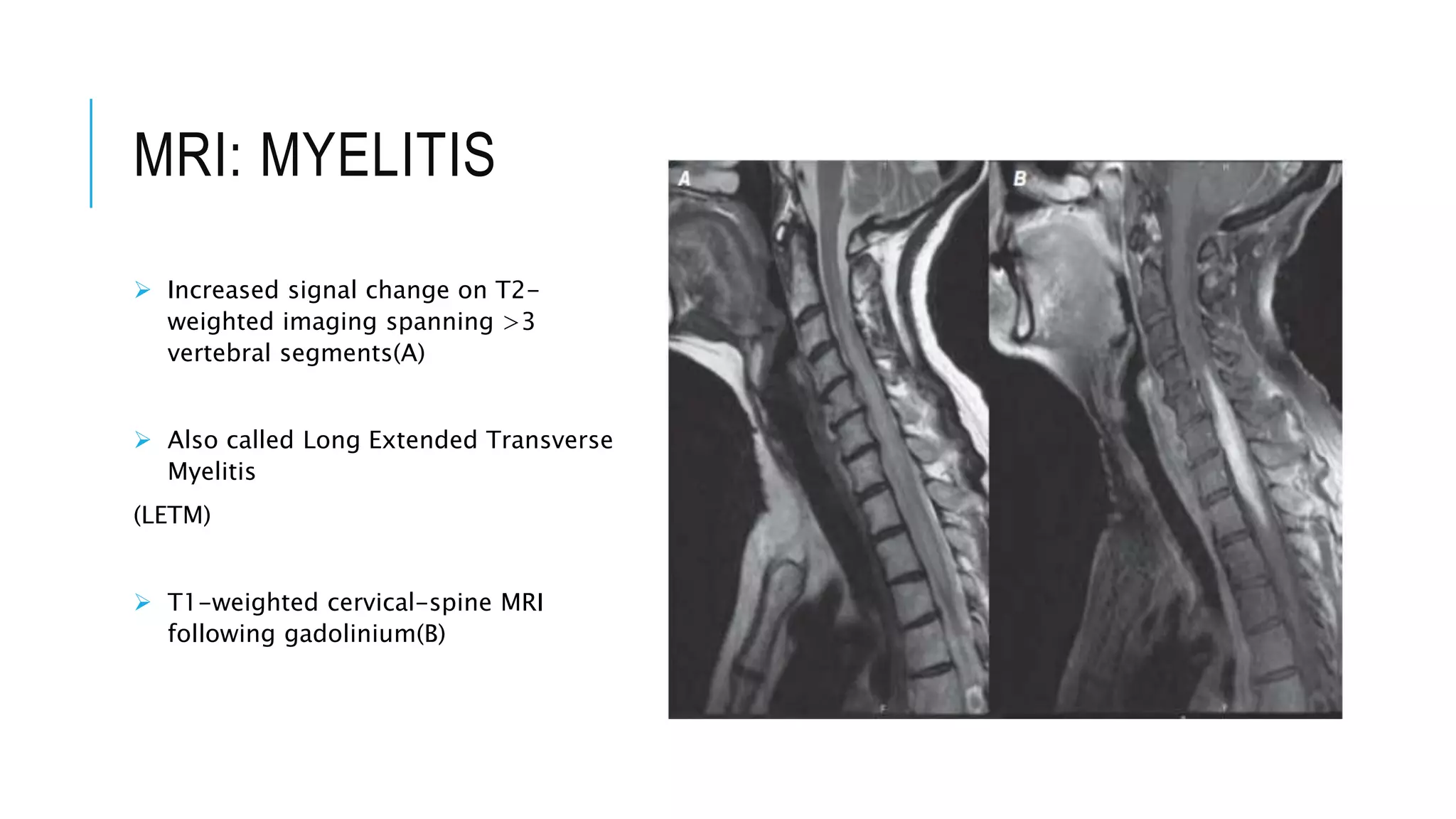 Neuromyelitis optica | PPTX