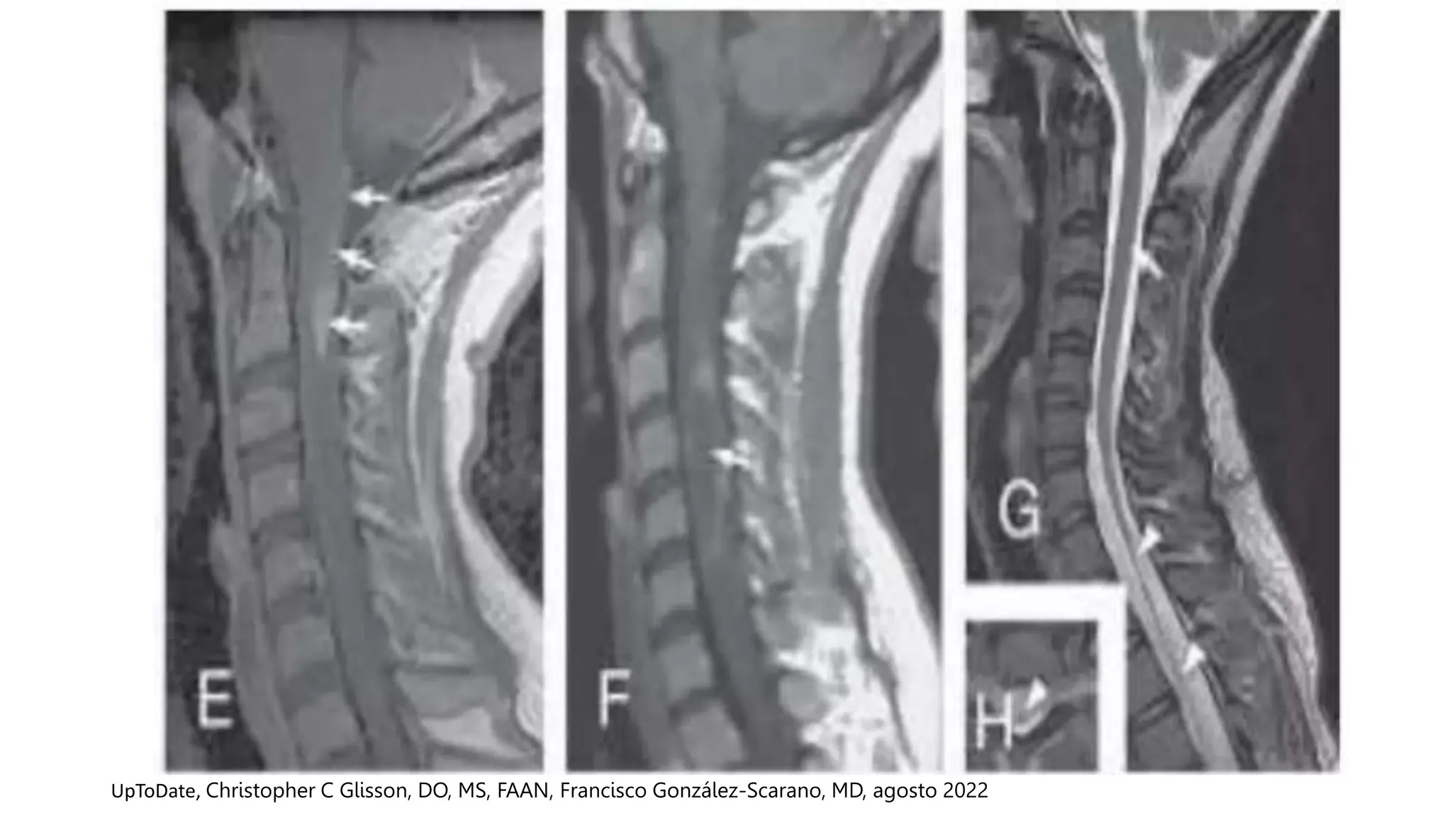 Neuromyelitis optica spectrum disorder (NMOSD).pptx