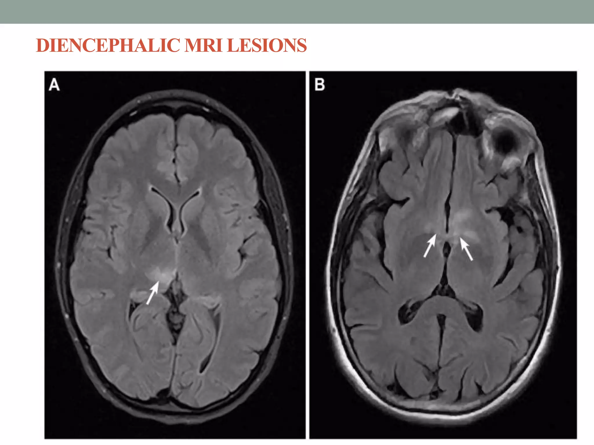 Neuromyelitis optica spectrum disorders | PPTX