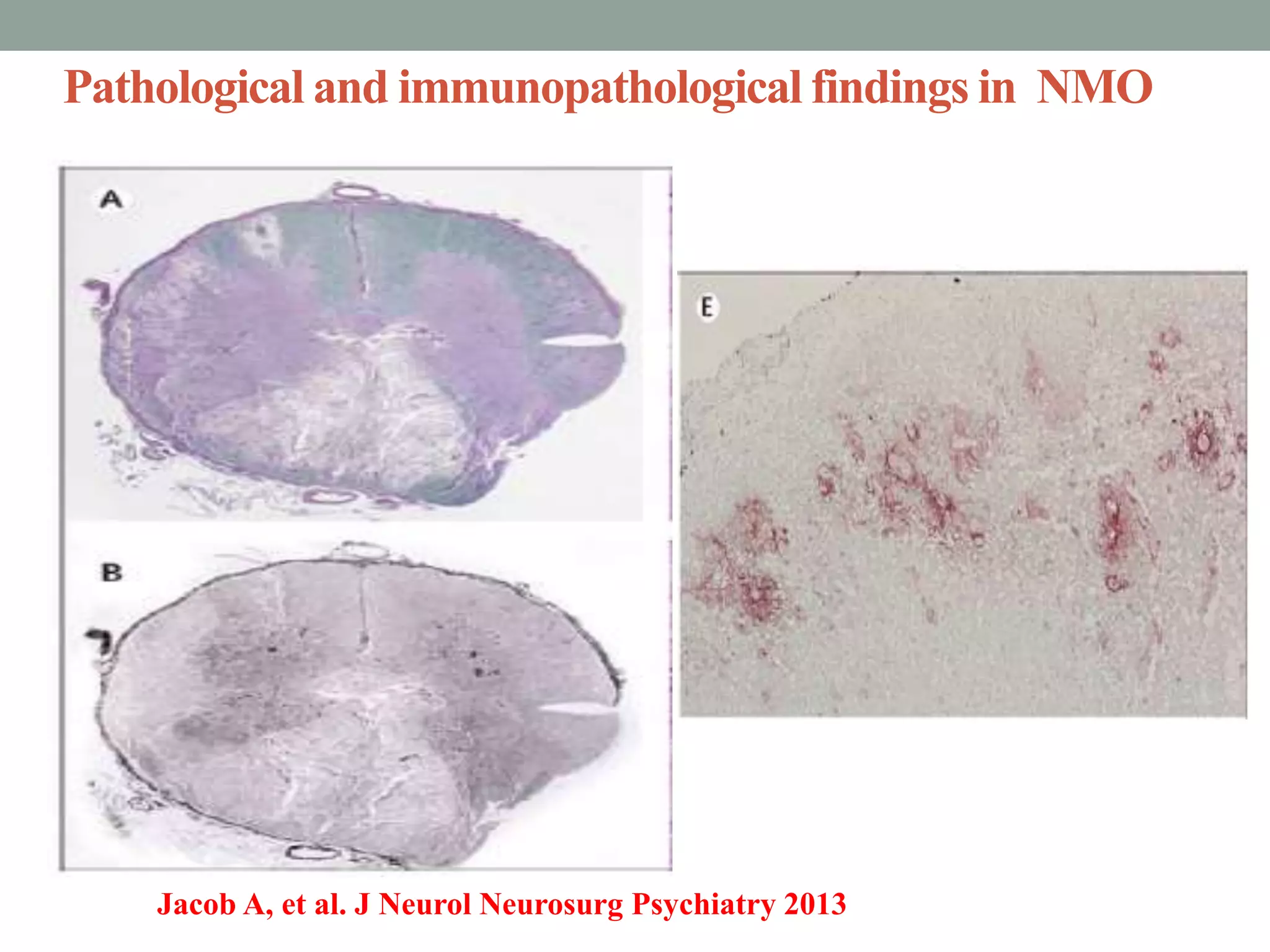 Neuromyelitis optica spectrum disorders | PPTX