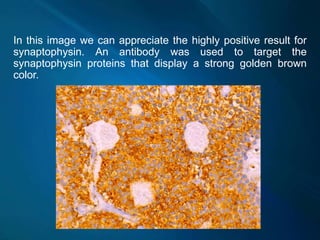 Neuronal cell tumors | PPTX