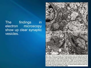 Neuronal cell tumors | PPTX