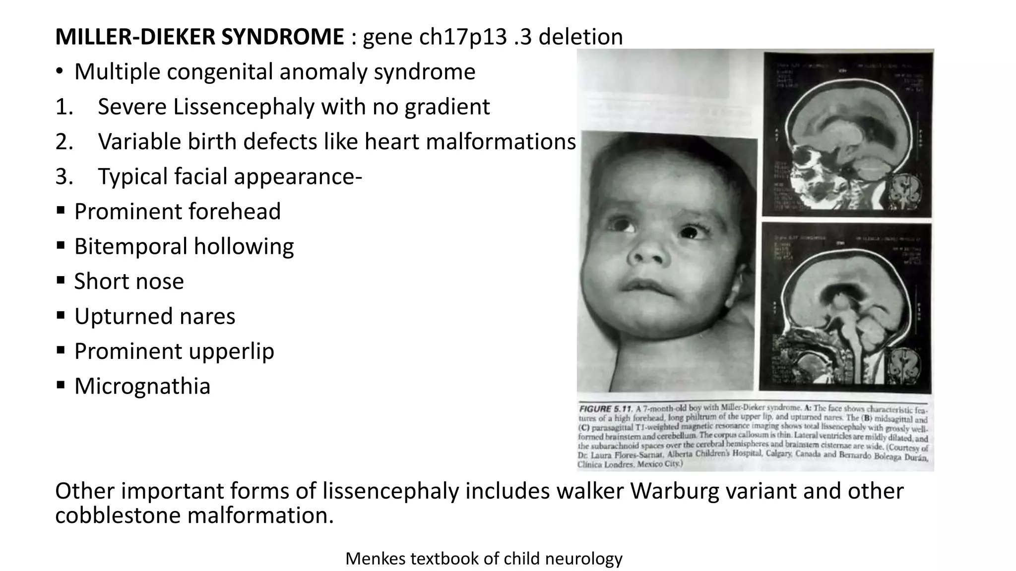 NEURONAL MIGRATION DISORDER (2) | PPTX
