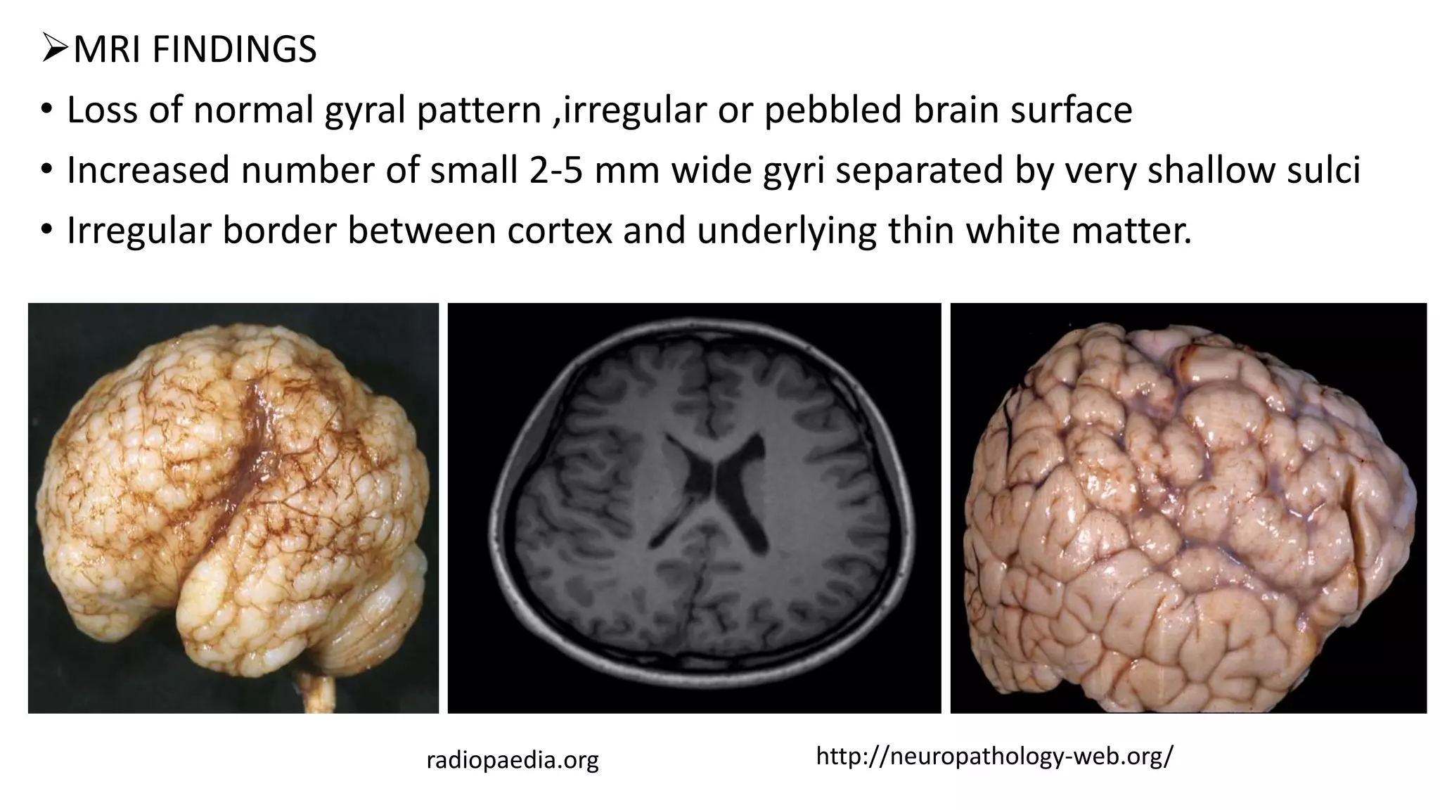 NEURONAL MIGRATION DISORDER (2) | PPTX