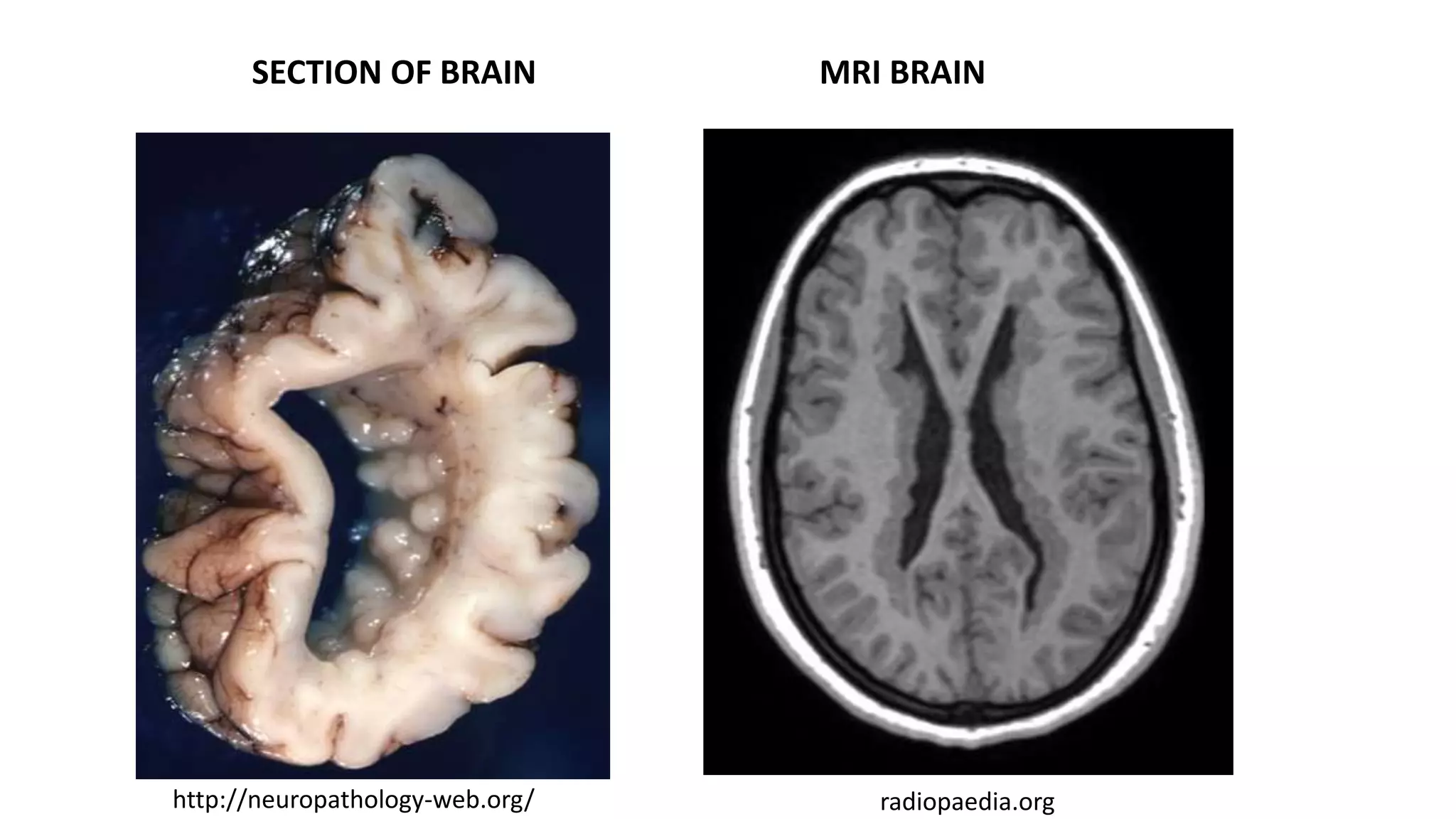 NEURONAL MIGRATION DISORDER (2) | PPTX