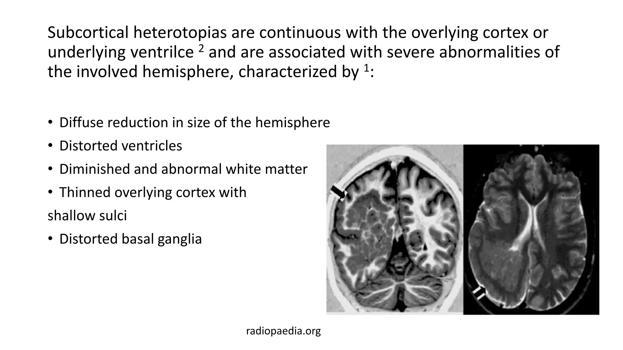 NEURONAL MIGRATION DISORDER (2) | PPTX