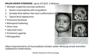 NEURONAL MIGRATION DISORDER (2) | PPTX