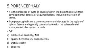 NEURONAL MIGRATION DISORDER (2) | PPTX