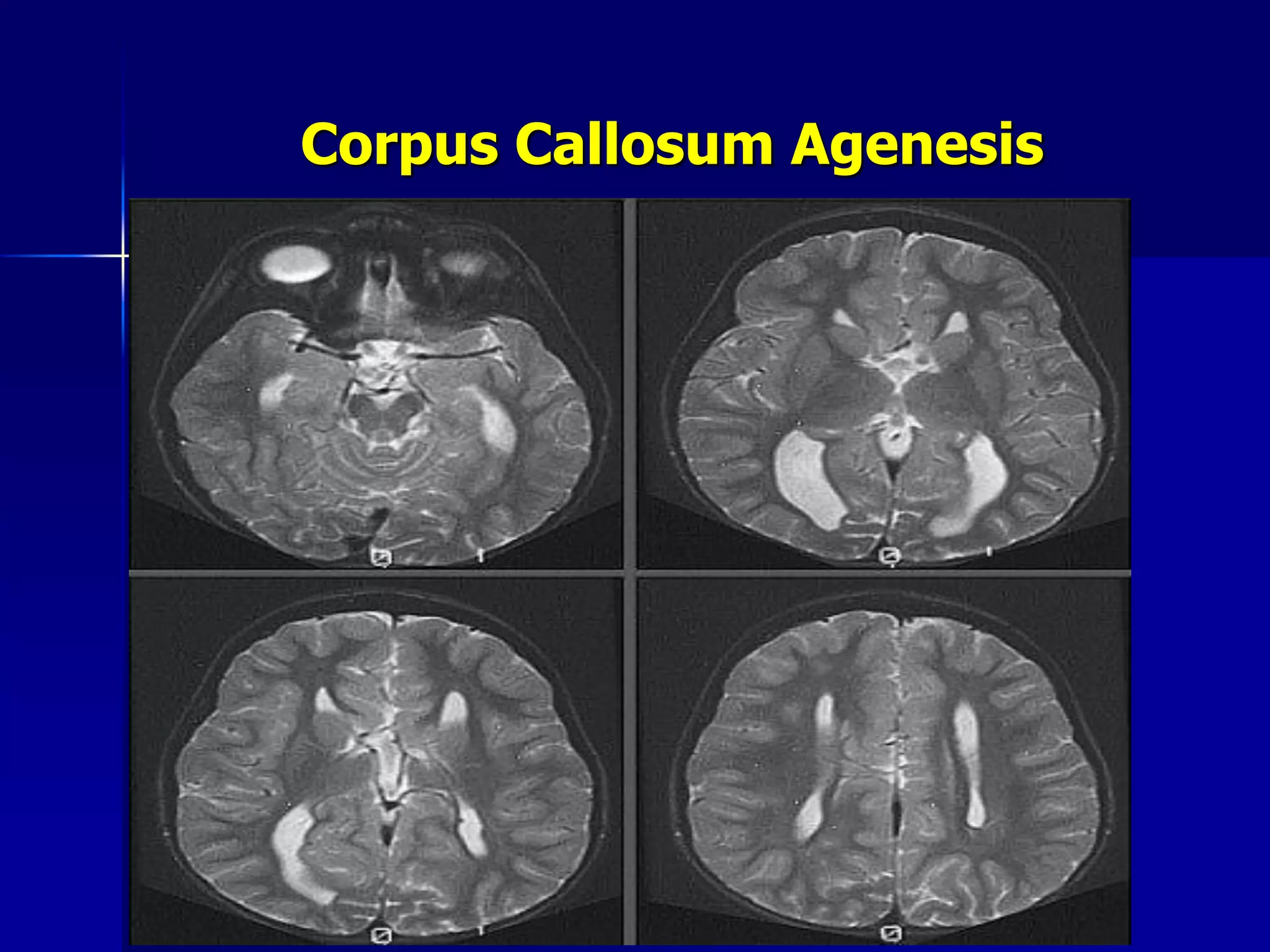 Neuronal migration disorders | PDF | Brain and Nervous System Disorders ...
