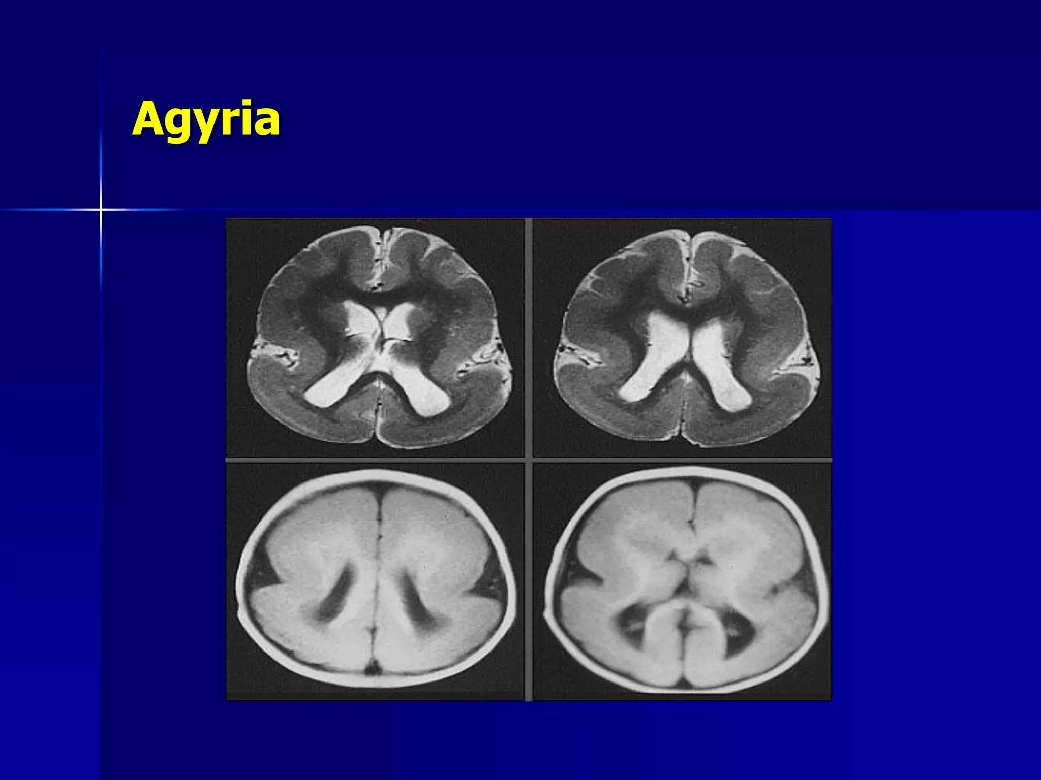 Neuronal migration disorders | PDF | Brain and Nervous System Disorders ...