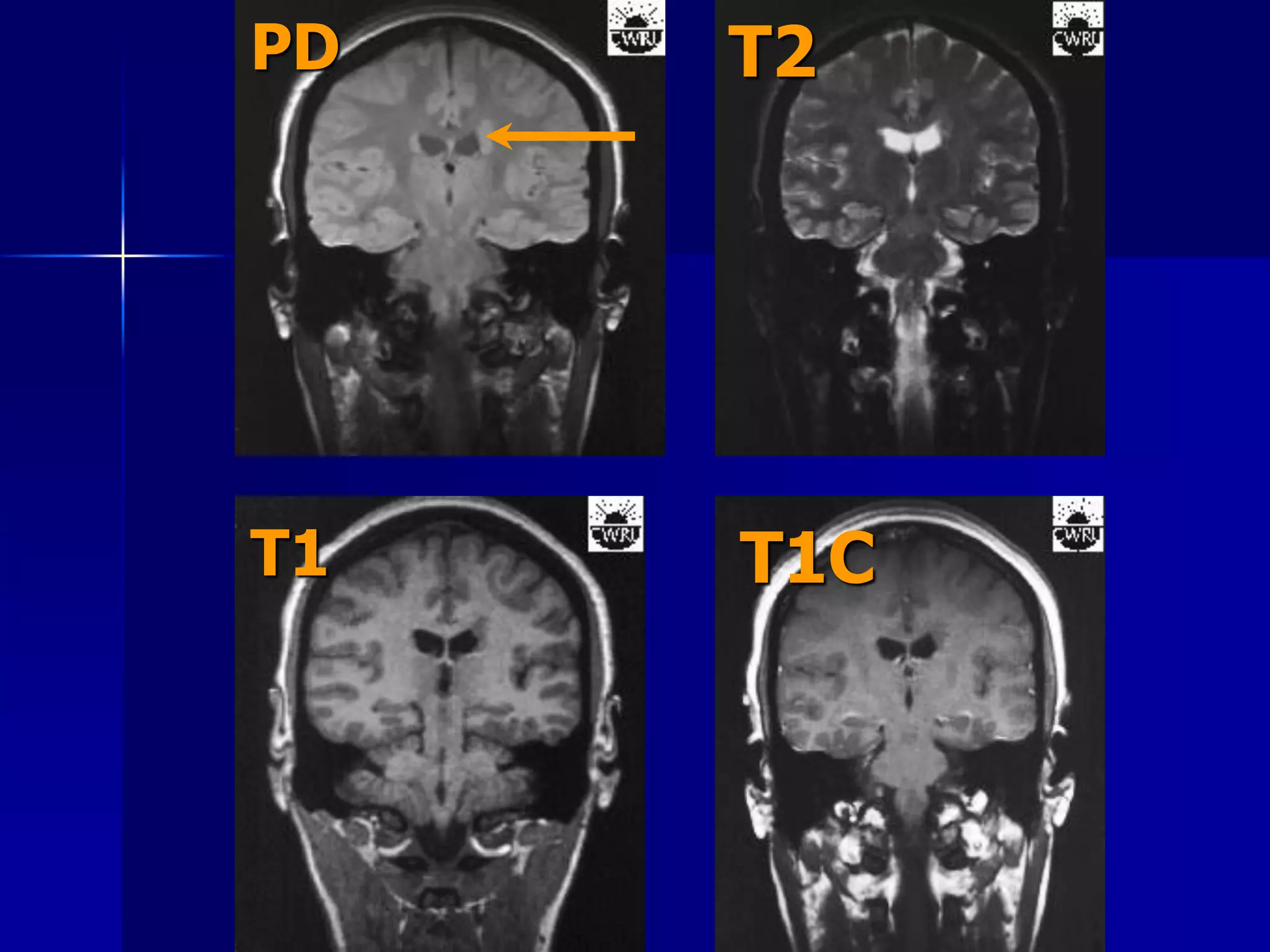 Neuronal migration disorders | PDF