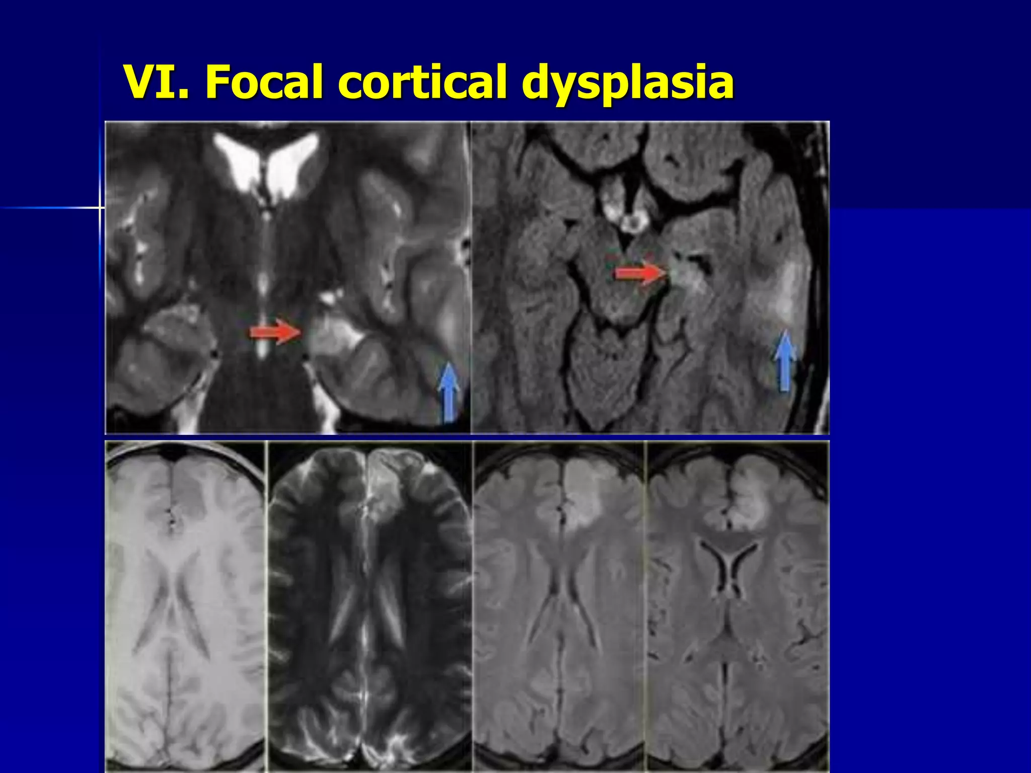 Neuronal migration disorders | PDF