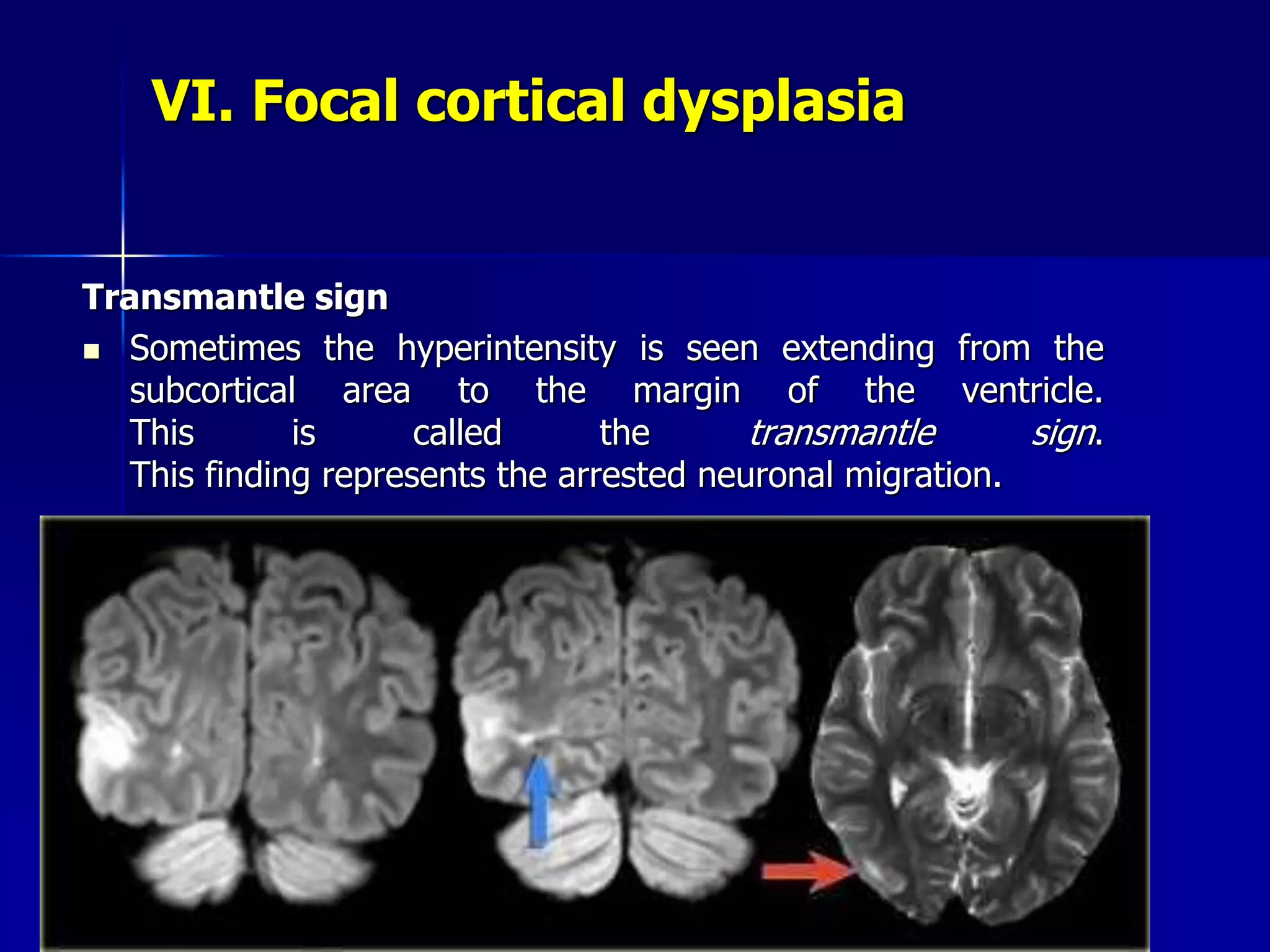 Neuronal migration disorders | PDF