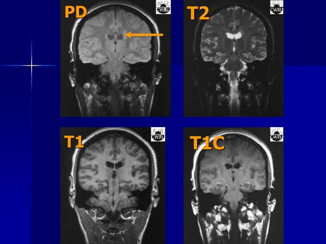 Neuronal migration disorders | PDF | Brain and Nervous System Disorders ...