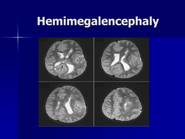 Neuronal Migration Disorders Ppt