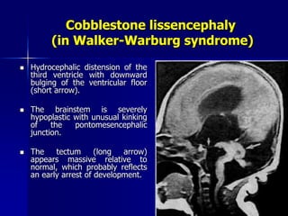Cobblestone Lissencephaly