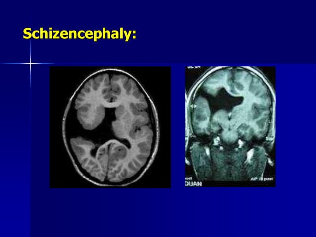 Neuronal migration disorders