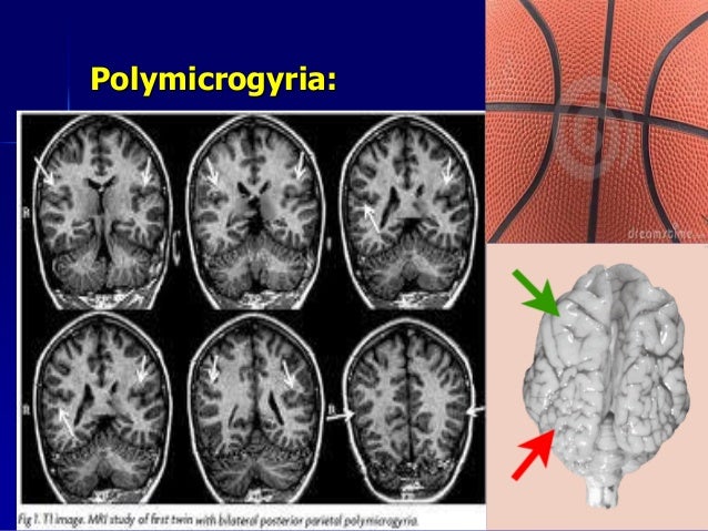 Neuronal migration disorders