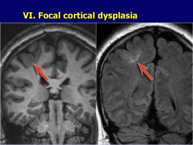 Neuronal migration disorders