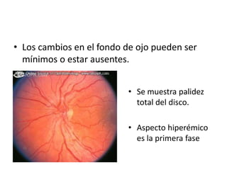 Neuropatía óptica Hereditaria de Leber | PPTX