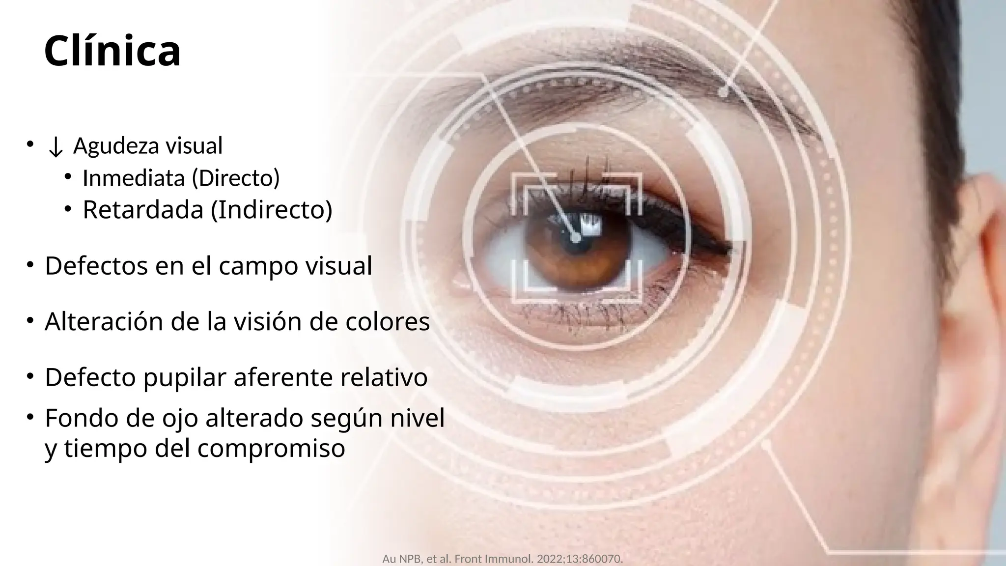 Neuropatía óptica traumática (Nervio óptico, defecto pupilar aferente ...
