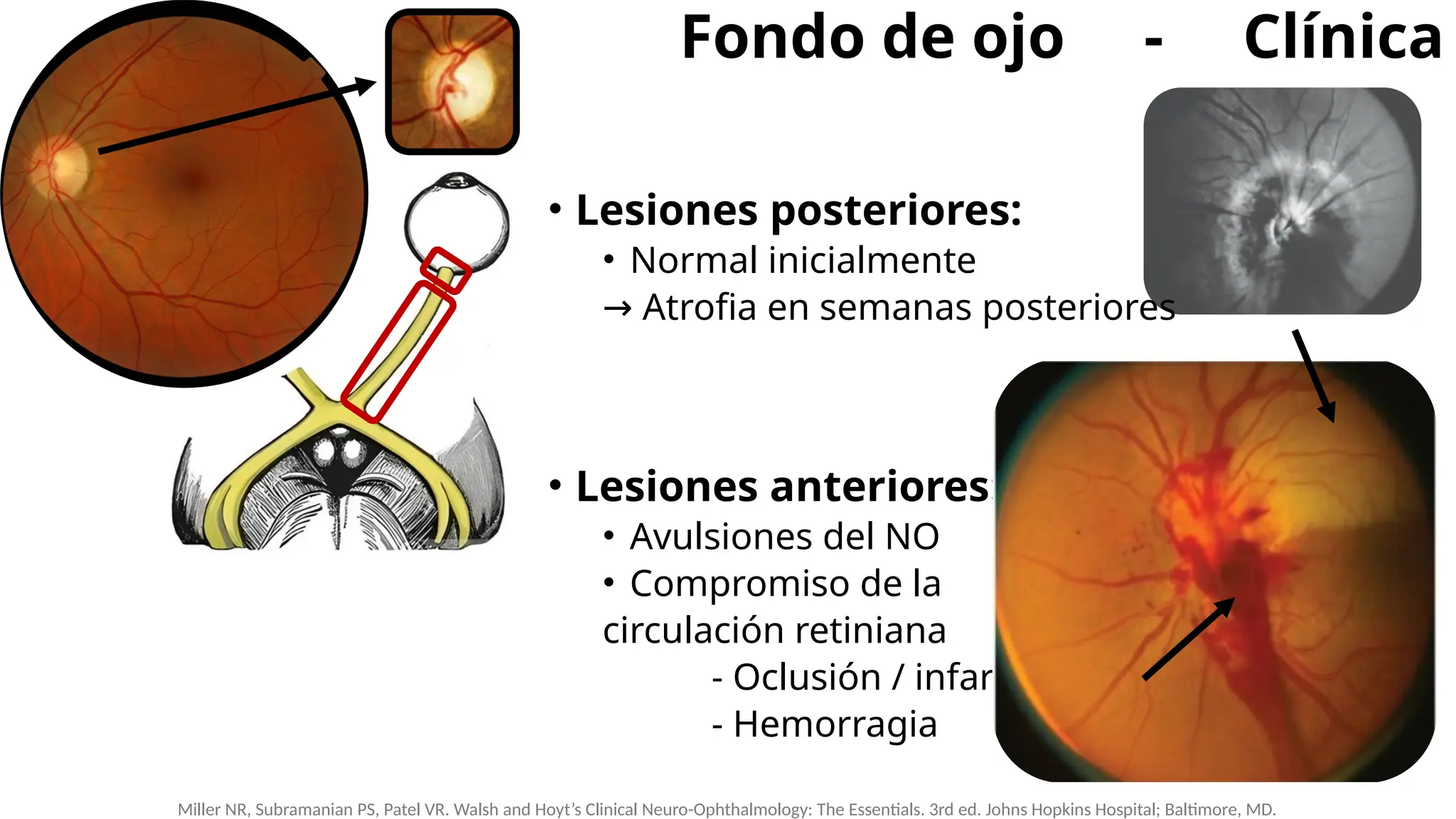 Neuropatía óptica traumática (Nervio óptico, defecto pupilar aferente ...