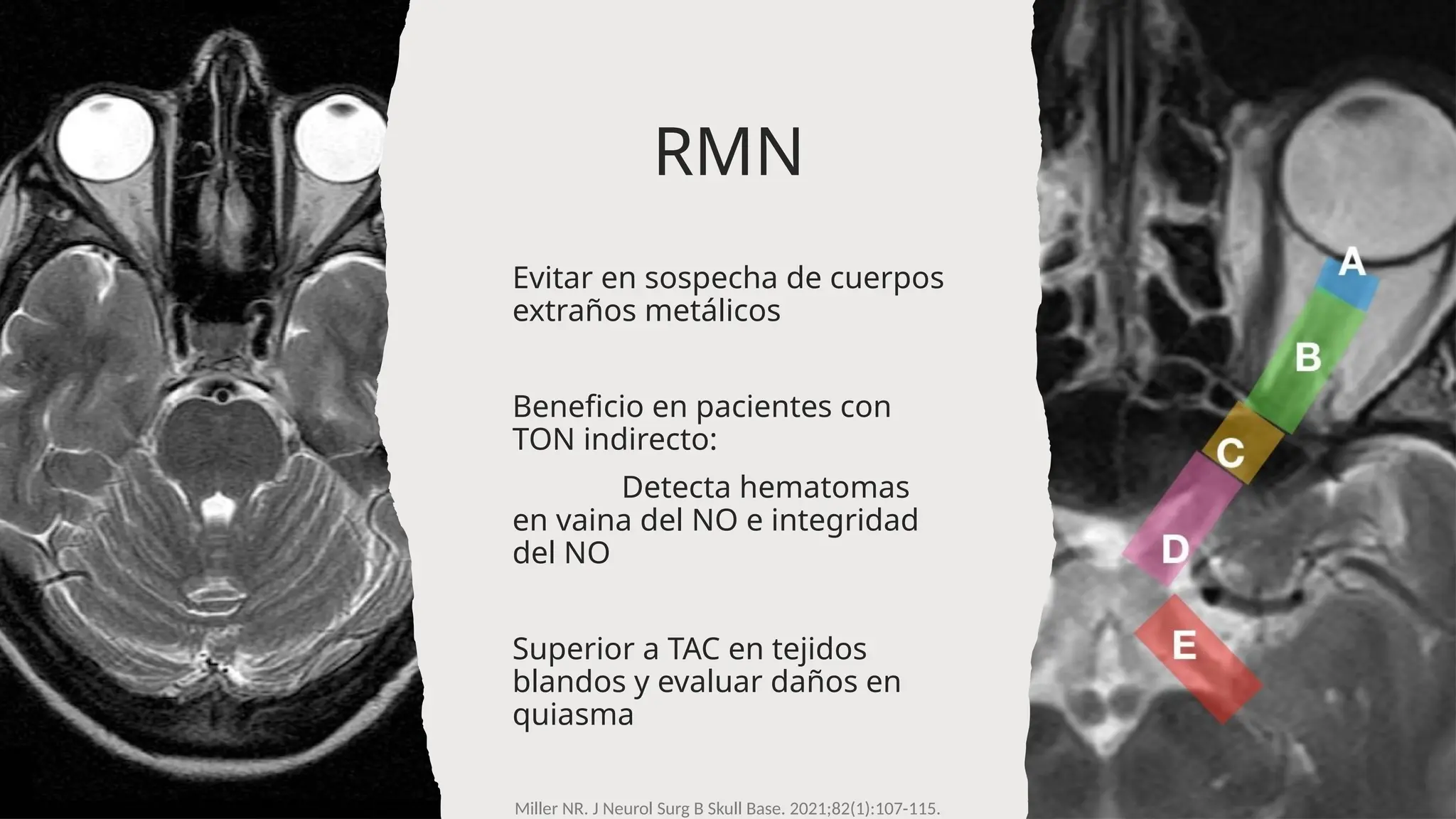 Neuropatía óptica traumática (Nervio óptico, defecto pupilar aferente ...