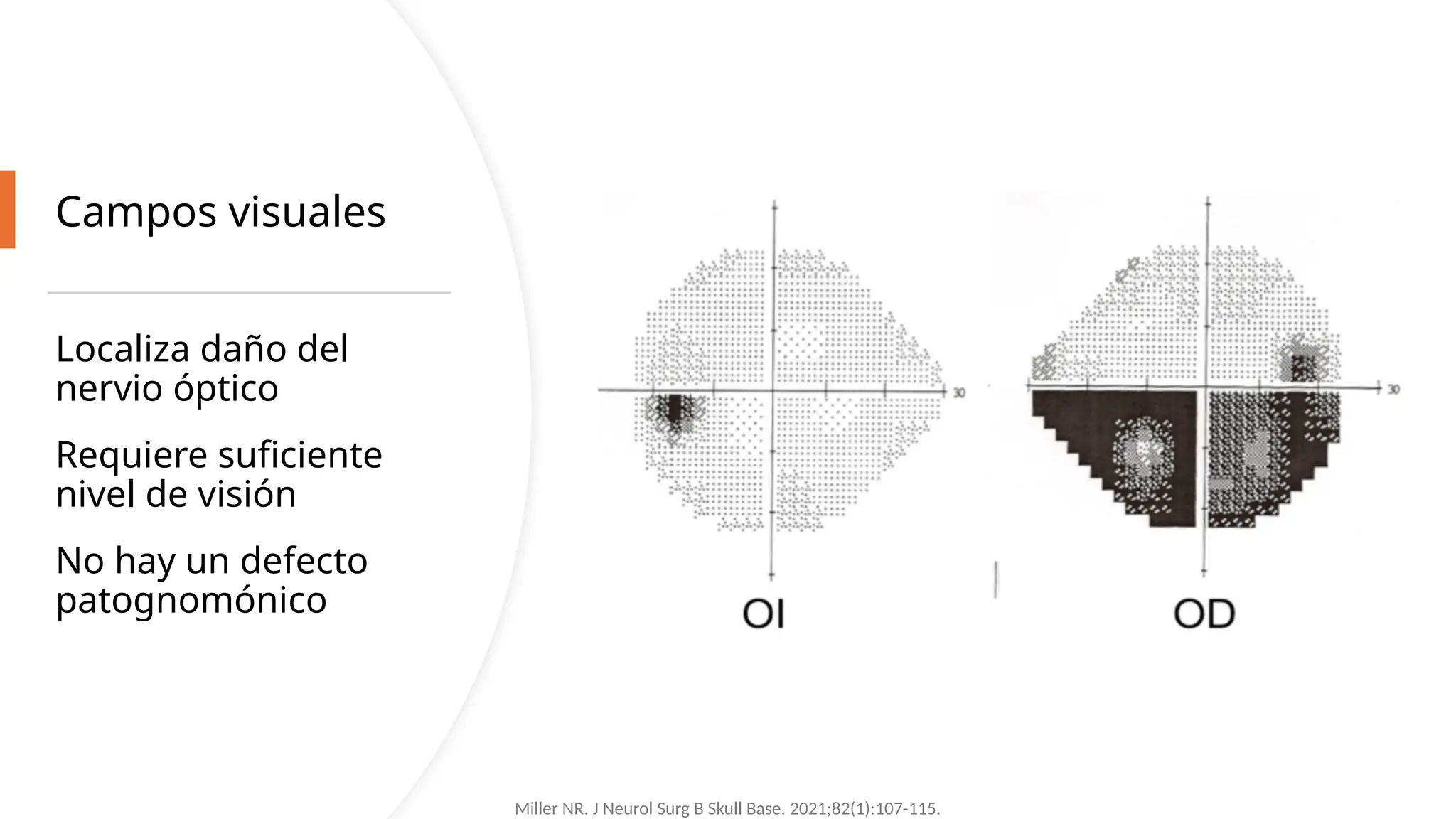 Neuropatía óptica traumática (Nervio óptico, defecto pupilar aferente ...