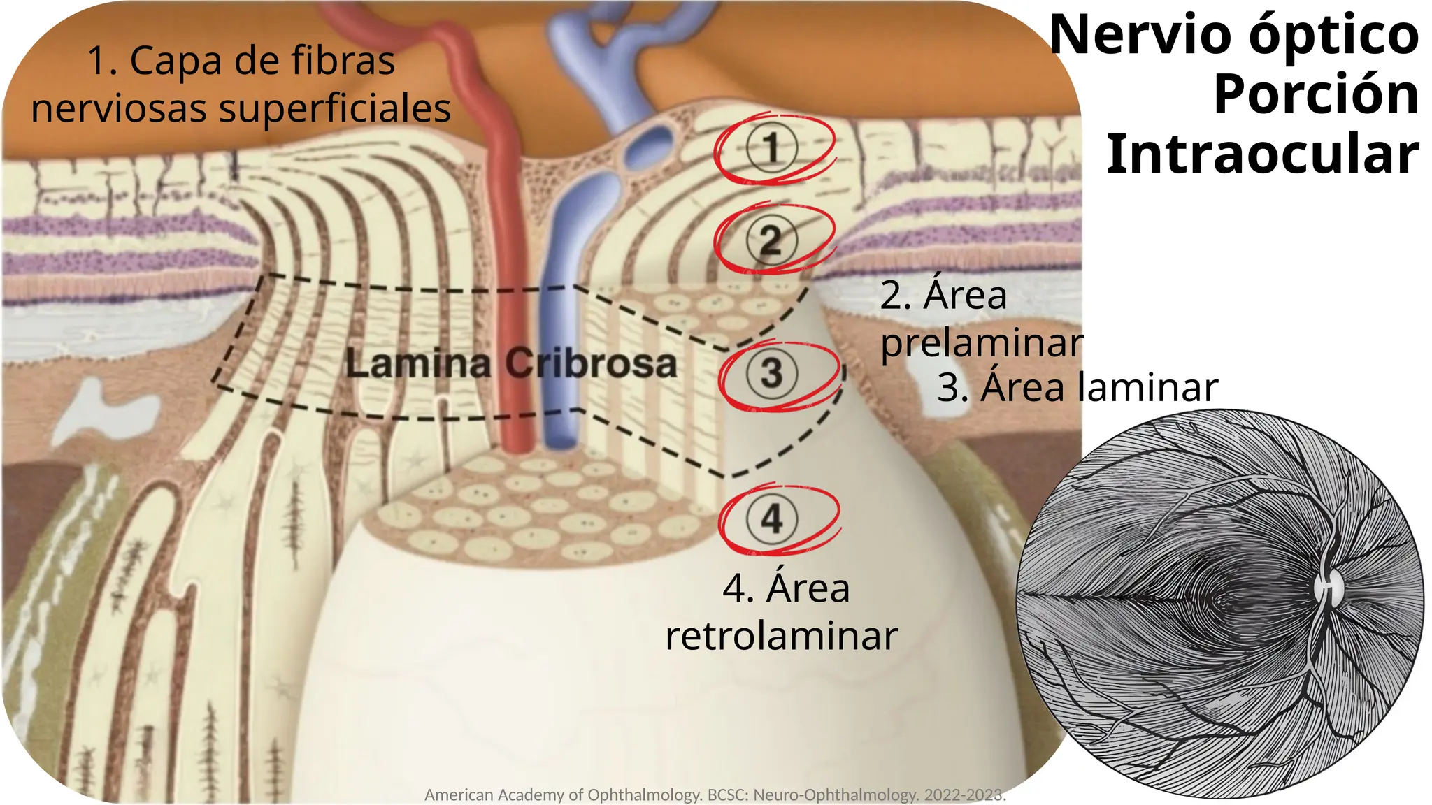 Neuropatía óptica traumática (Nervio óptico, defecto pupilar aferente ...