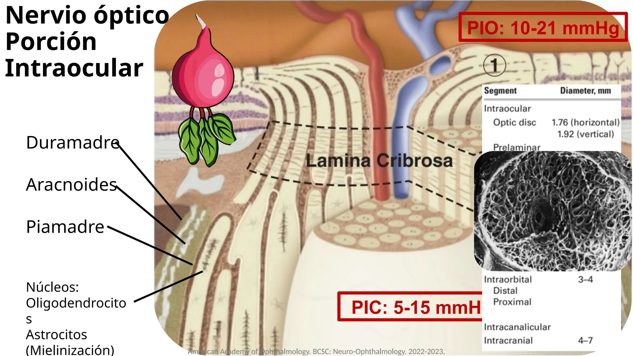 Neuropatía óptica traumática (Nervio óptico, defecto pupilar aferente ...