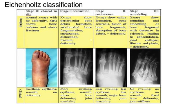 Neuropathic arthropathy diagnosis and management guidelines | PPT