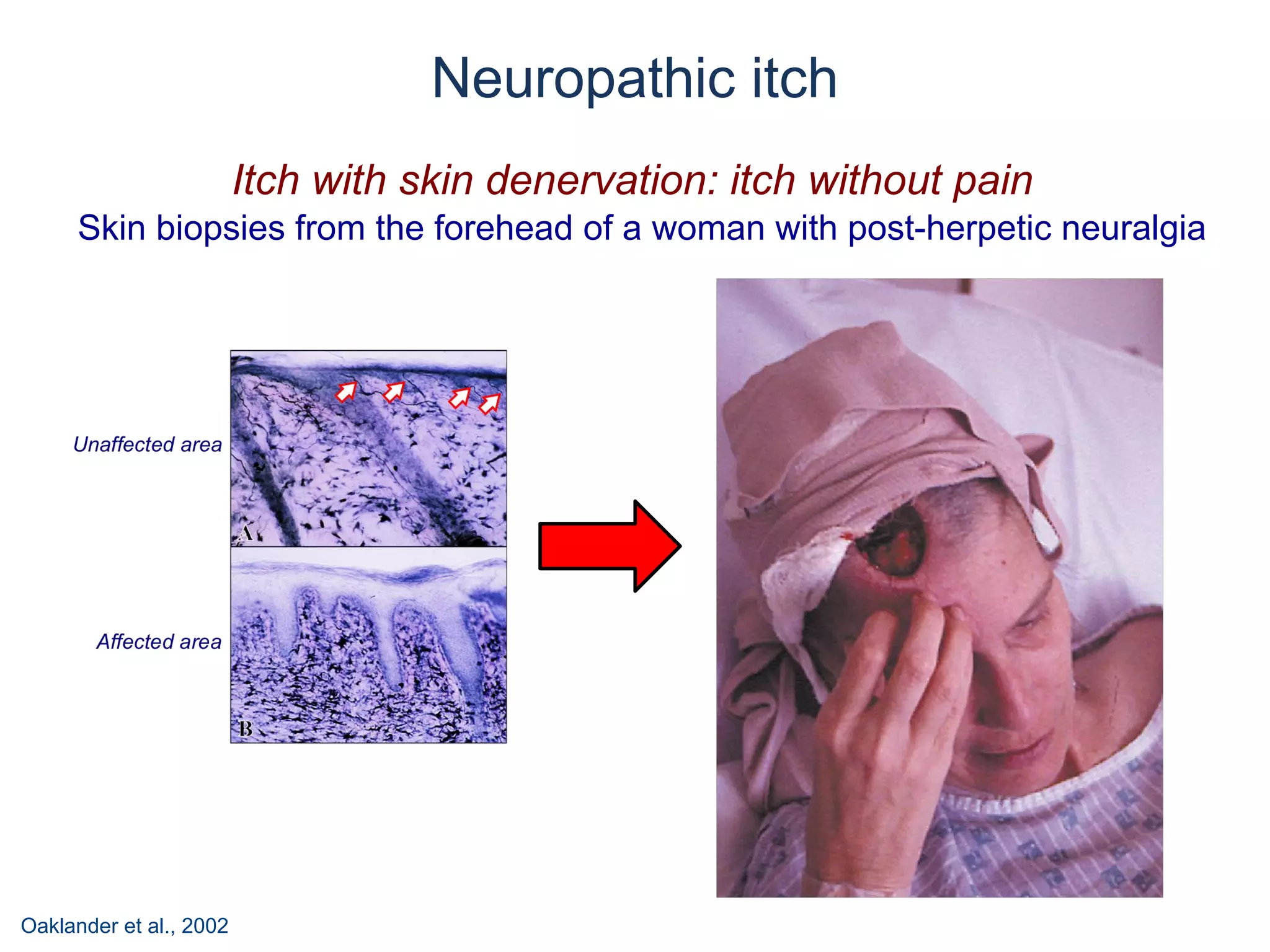 Neuropathic itch (2014) | PDF | Brain and Nervous System Disorders ...