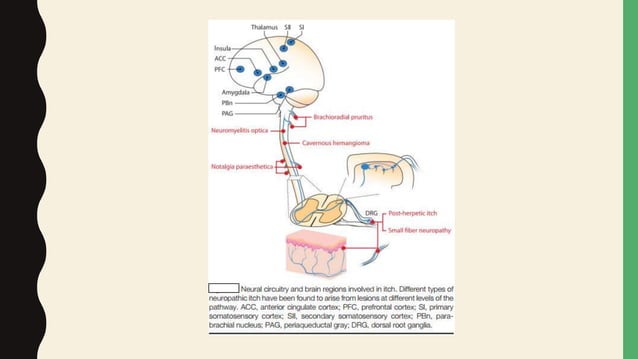 Neuropathic Itch | PPTX