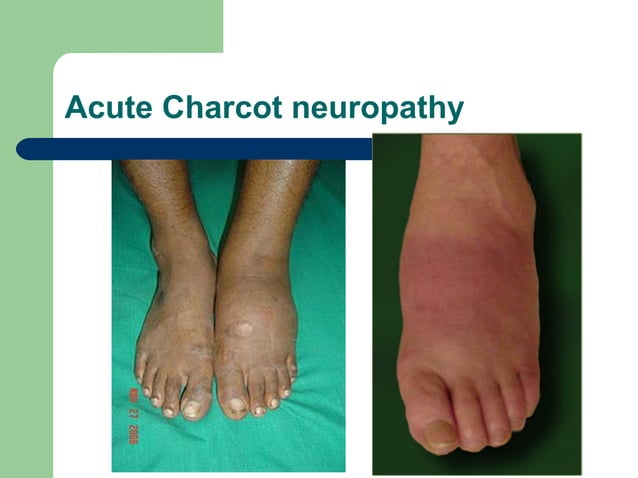Neuropathic (Charcots) joints | PPT