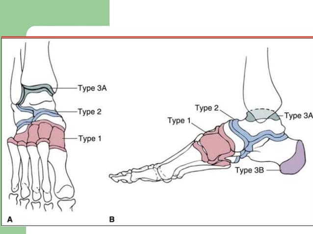 Neuropathic (Charcots) joints | PPT