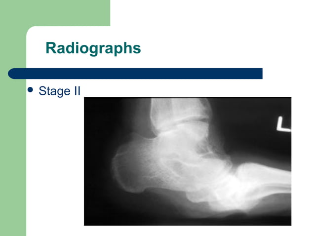Neuropathic (Charcots) joints | PPT