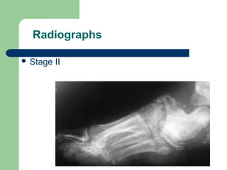 Neuropathic (Charcots) joints | PPT