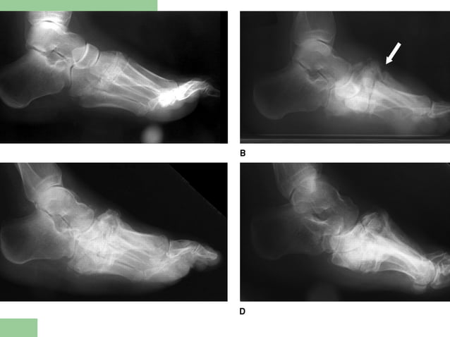 Neuropathic (Charcots) joints | PPT