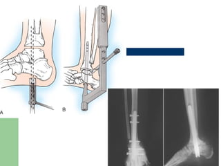 Neuropathic (Charcots) joints | PPT